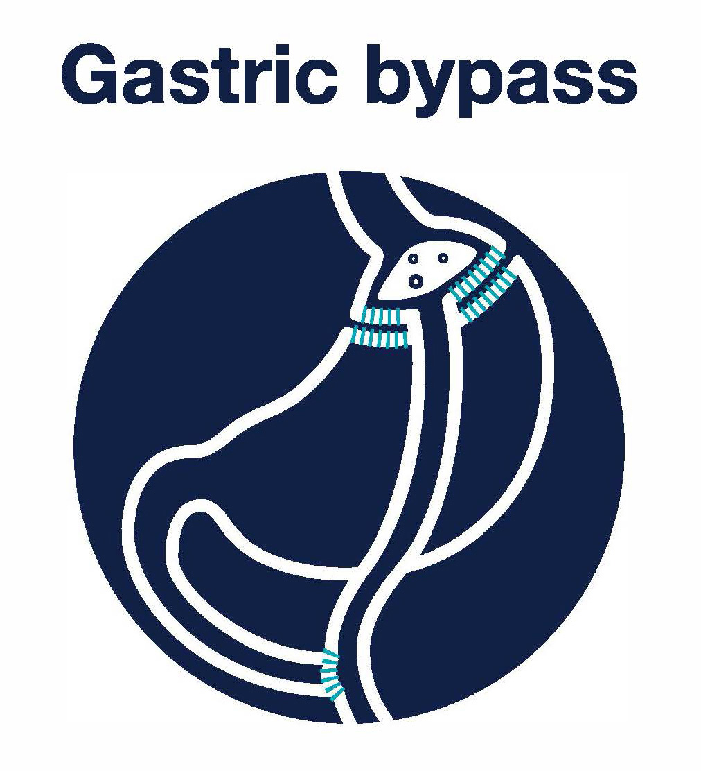 Laparoscopic Gastric Bypass | UCSF Department of Surgery